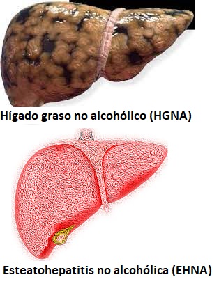 Enfermedad del hígado graso: Qué es y qué hacer | Doctor Benjamin Díaz Curiel