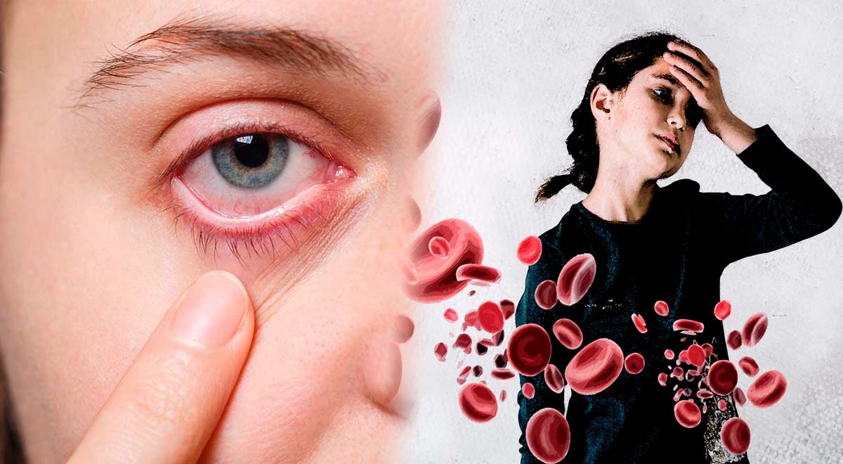 ¿Pasa por alto los signos sutiles de la anemia? - Doctor Benjamin Díaz ...