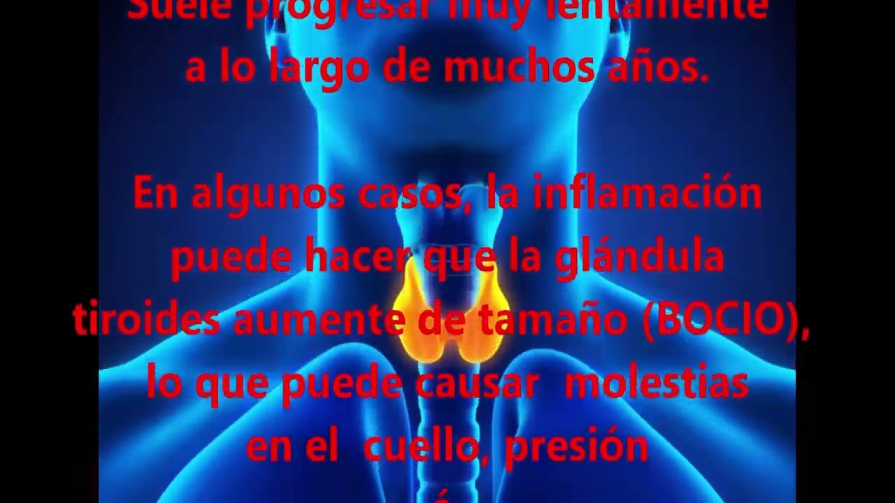 Tiroiditis de Hashimoto... Cuales son los sintomas? Dr. Benjamín Díaz ...